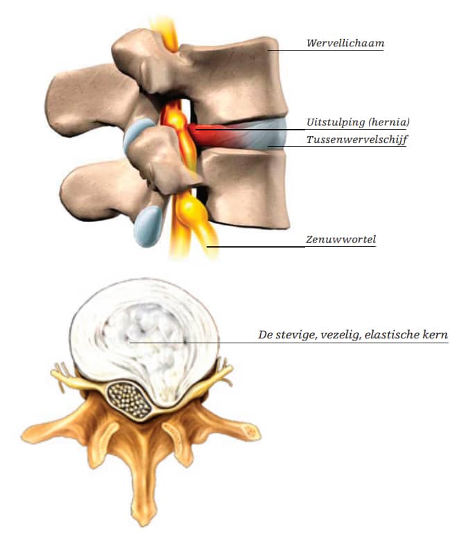 Een rugoperatie - koelenisbeter.nl